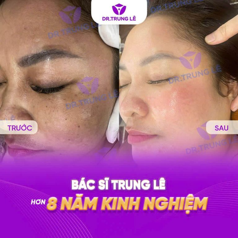Công Nghệ Trị Nám Mirco Melasu Nhật Bản - Sạch Tận Gốc Nám