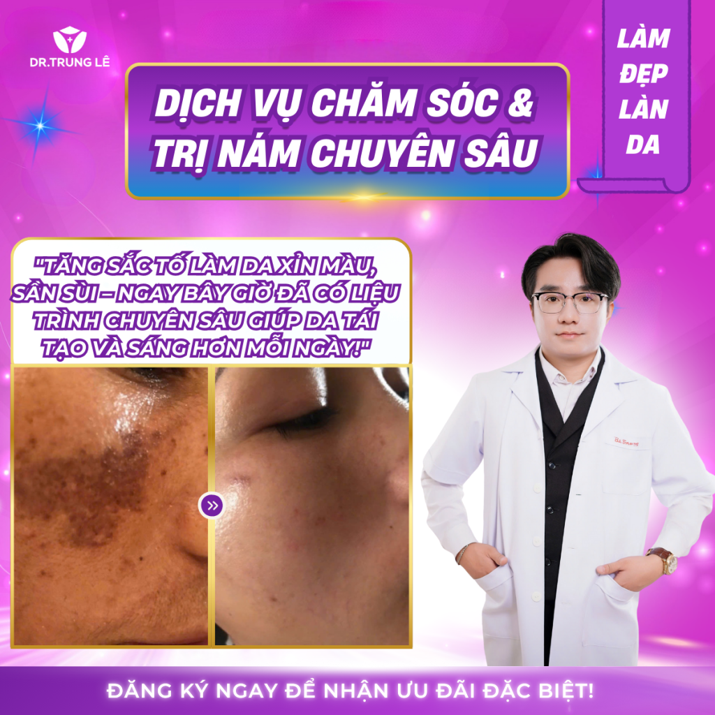 Trị Nám Bằng Công Nghệ Melasu – Hiệu Quả Sau 1 Liệu Trình